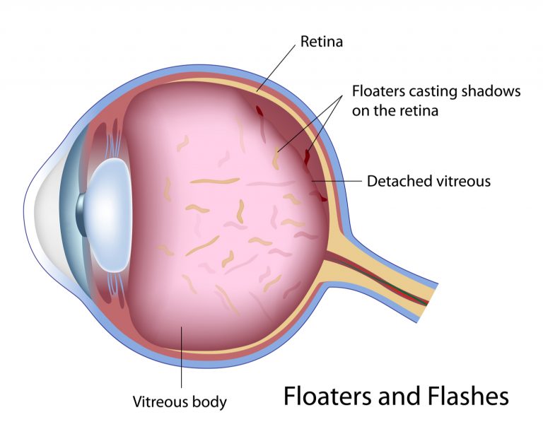 Floaters - Eye Center South