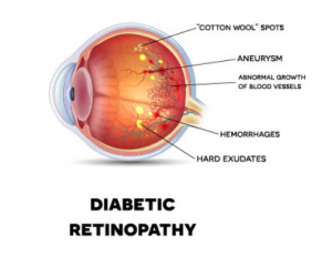 Diabetic Retinopathy - Eye Center South