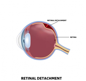 Retinal Detachment - Eye Center South