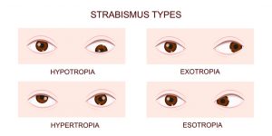 Strabismus - Eye Center South
