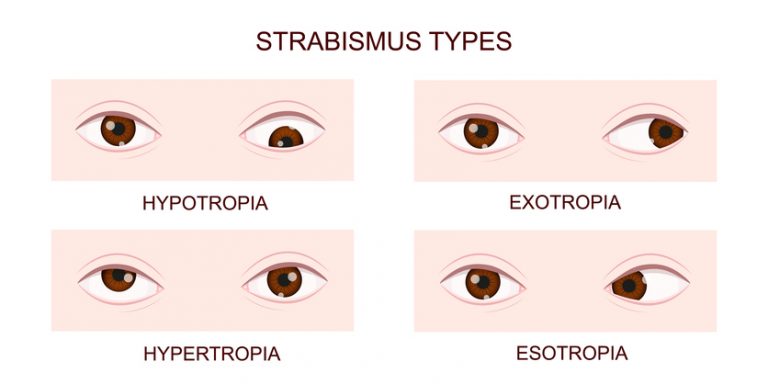 Strabismus - Eye Center South