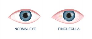 Removal of Pinguecula - Eye Center South